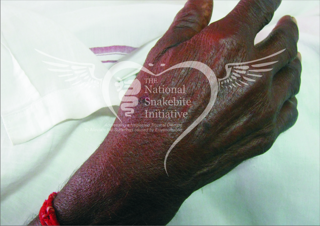 Snakebite a Neglected Tropcal Disease