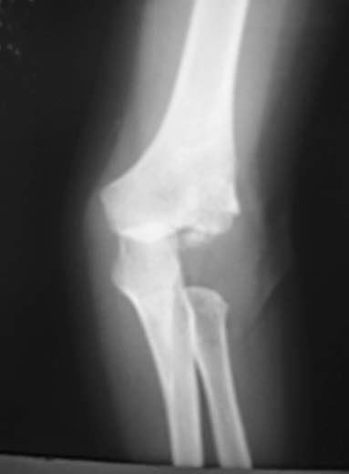 Figura 6. Codo valgo postraumático.