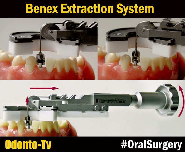 ORAL SURGERY: Benex Extraction System - Odonto-Tv