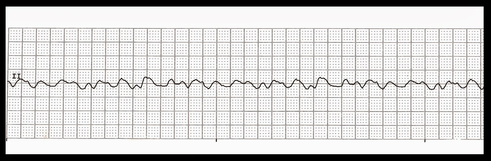 Practice EKG Strips 380