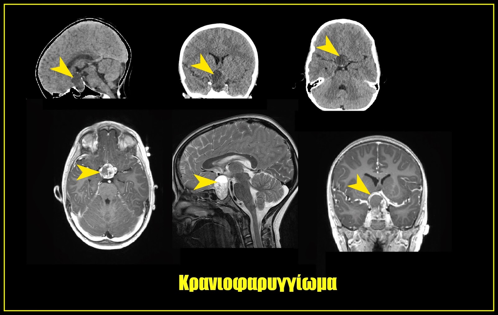 Κωνσταντίνος Χ. Δαβανέλος: Κρανιοφαρυγγίωμα.