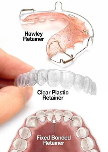 North Coast Orthodontics : Understanding Retainers After Braces