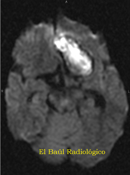 El Baúl Radiológico: 2) QUISTE DERMOIDE INTRACRANEAL (Intracranial ...