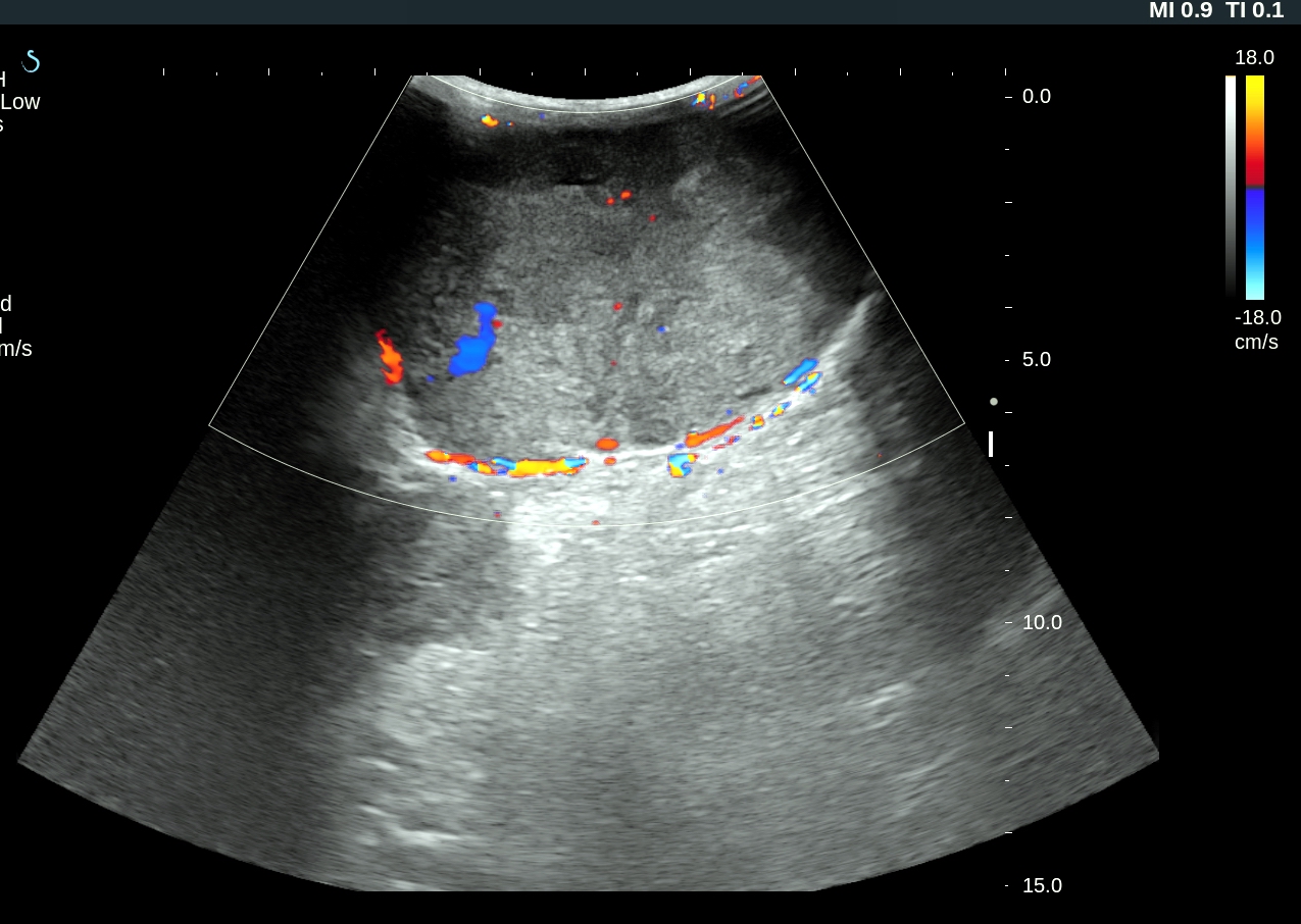 VIETNAMESE MEDIC ULTRASOUND: CASE 395: MAJOR LABIA TUMOR, Dr PHAN THANH ...
