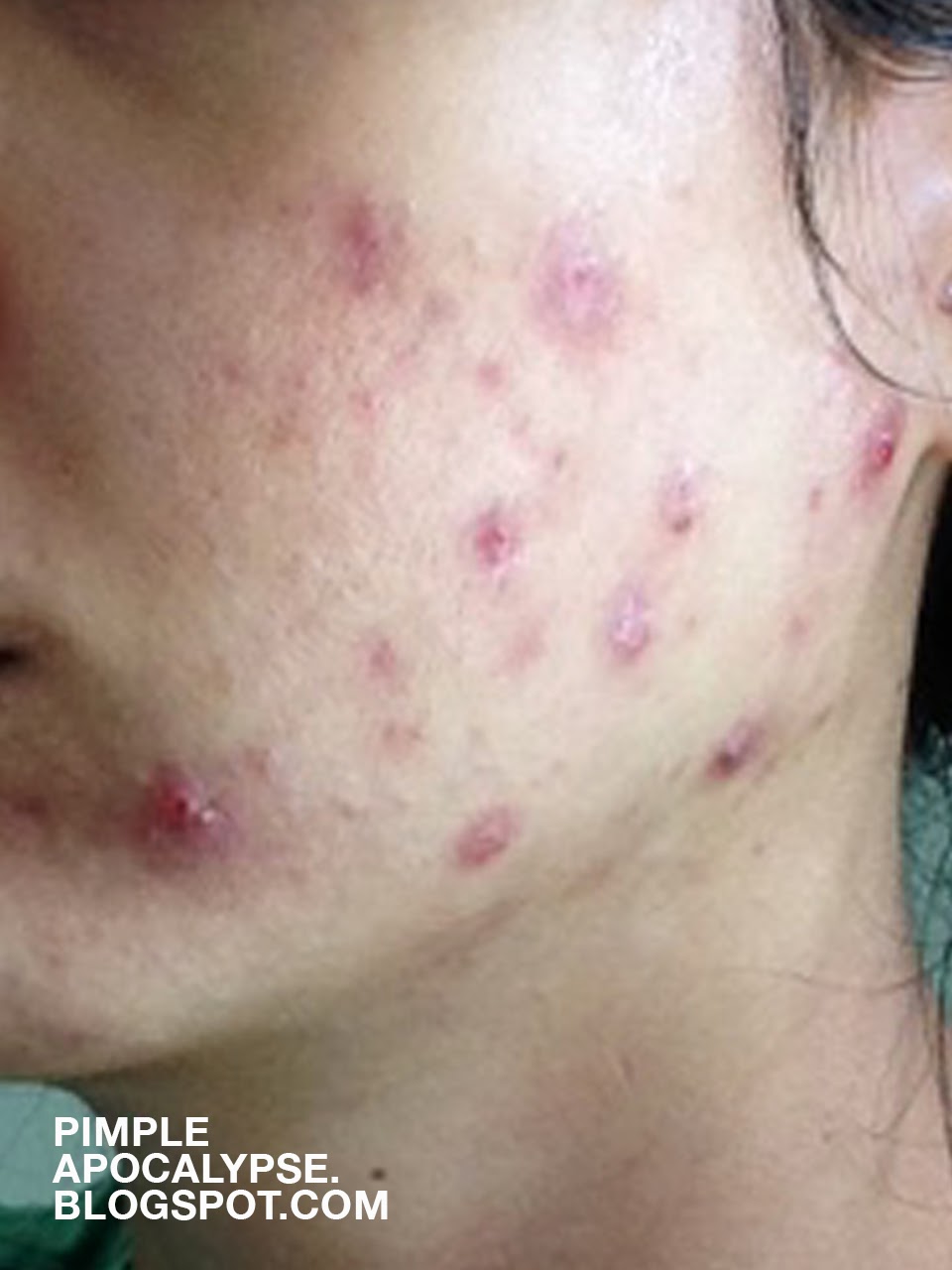 pimple apocalypse: benzoyl peroxide | not for me!