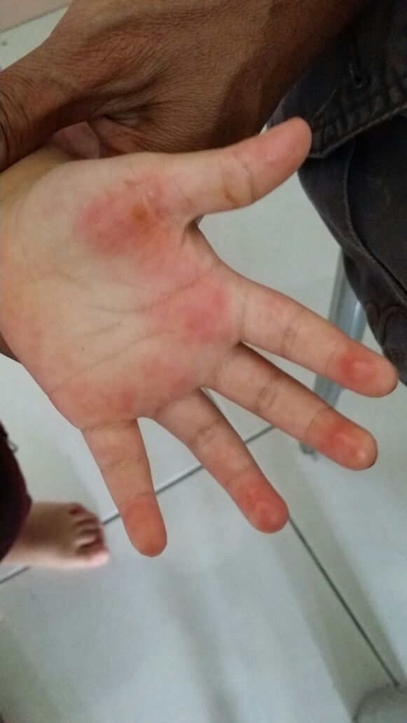 Tangan Melecur!!! - wayne harraz