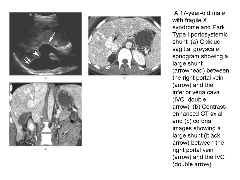 BÀI SOẠN VỀ SIÊU ÂM CHẨN ĐOÁN: Hepatic Vascular Shunts