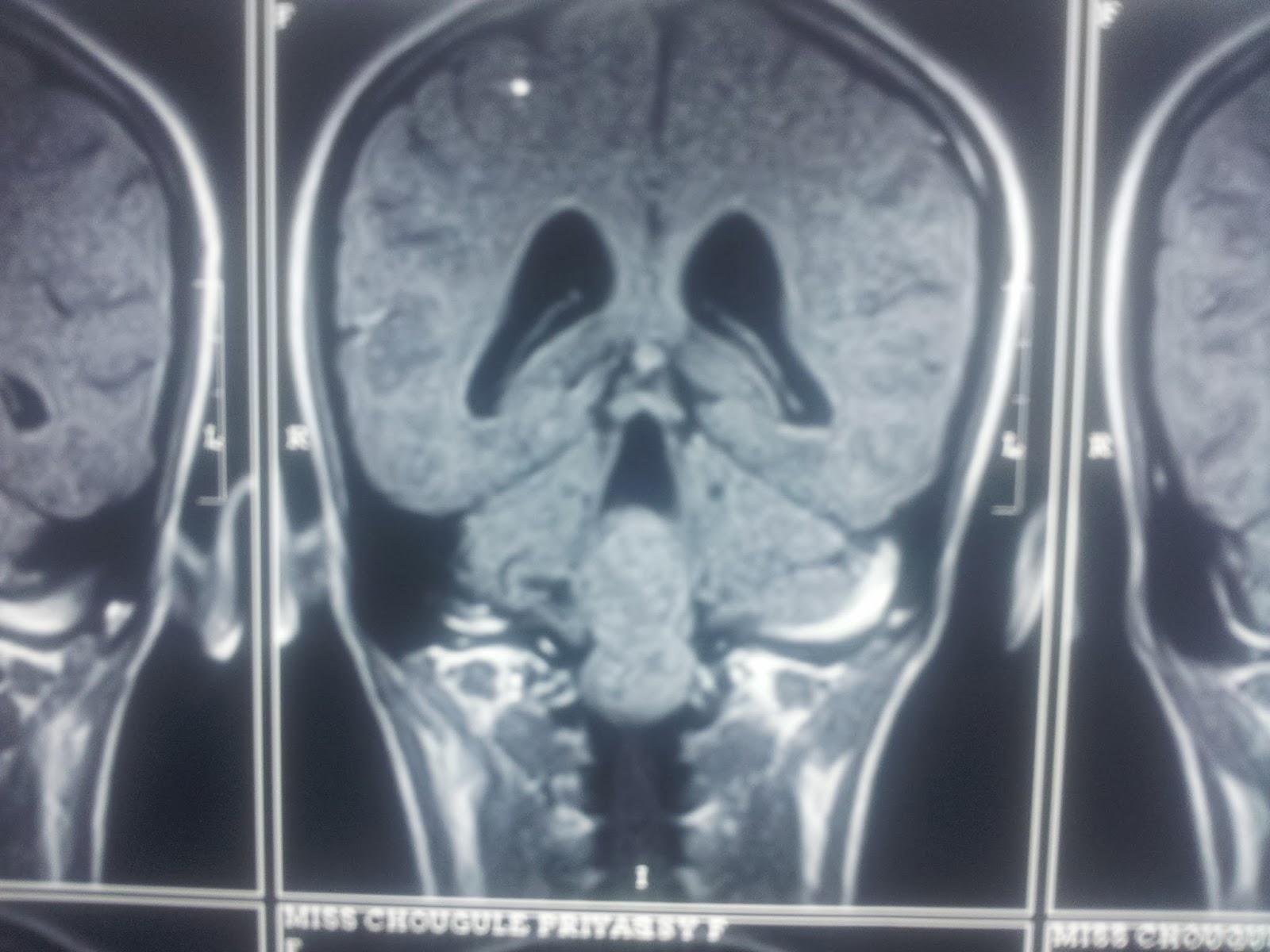 Dr Balaji Anvekar FRCR: Spinal Drop Metastasis from Choroid Plexus ...