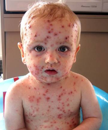 Dr.Vipul's Blog: Chicken Pox / અછબડા