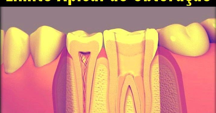 ENDODONTIA: Limite Apical de Obturação - Video 1 - Odonto-Tv