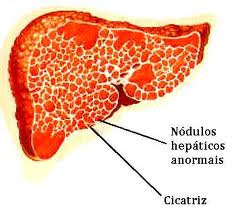 Blog Dr. Carlos: Cirrose hepática