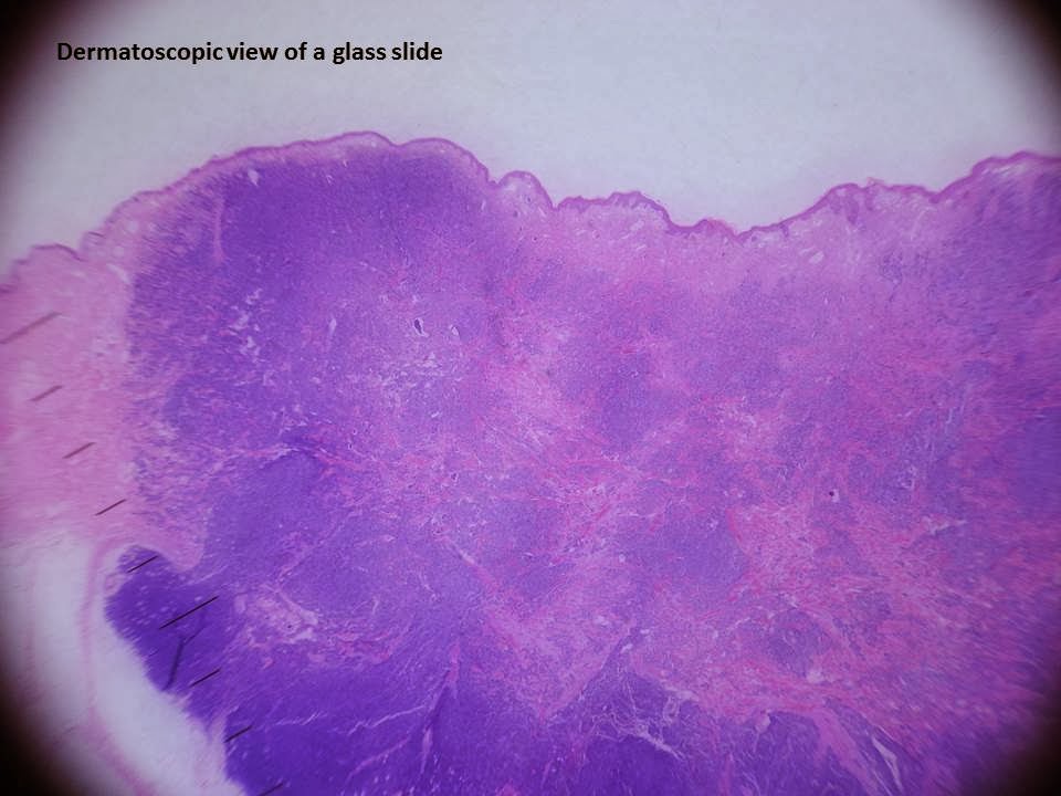 Dermpath Made Simple - Neoplastic: Merkel Cell Carcinoma