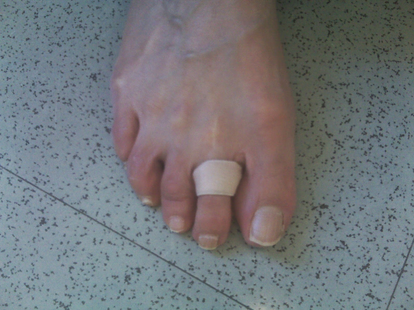 Foot and Ankle Problems By Dr. Richard Blake: Painful 2nd MPJ: Email Advice