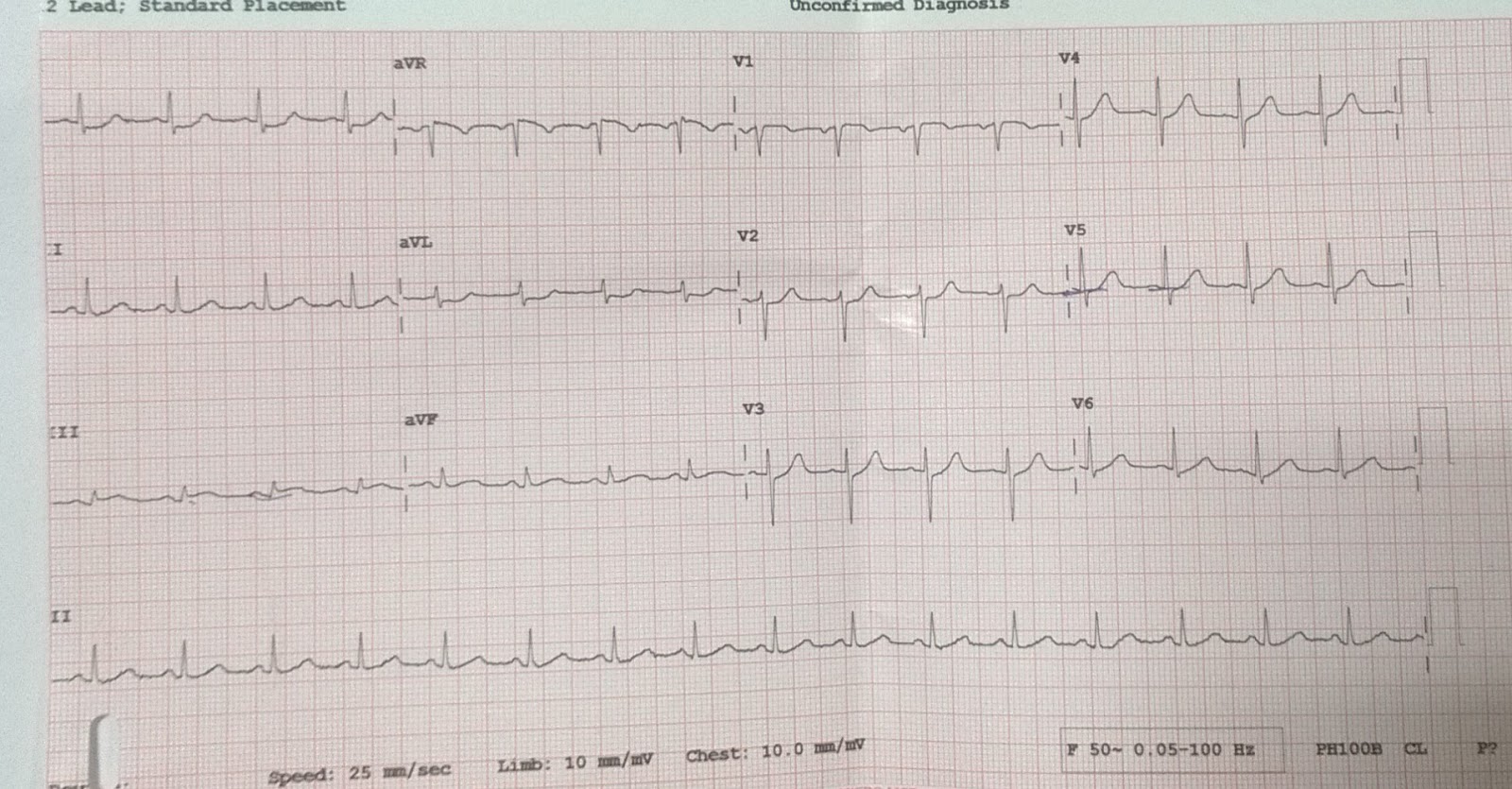Anterior Myocardial Infarction Ecg