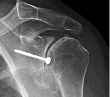 Shoulder Arthritis/Joint Replacement Rotator cuff tears: The Latarjet ...