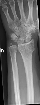 Elämyskameli: 11: ranteen natiiviröntgen