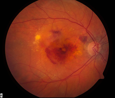 Degeneracion Macular
