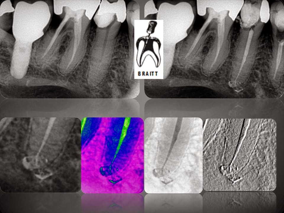 Endodontia Dr. Henrique Braitt: Zona Crítica Apical