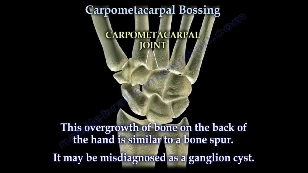 Carpometacarpal bossing