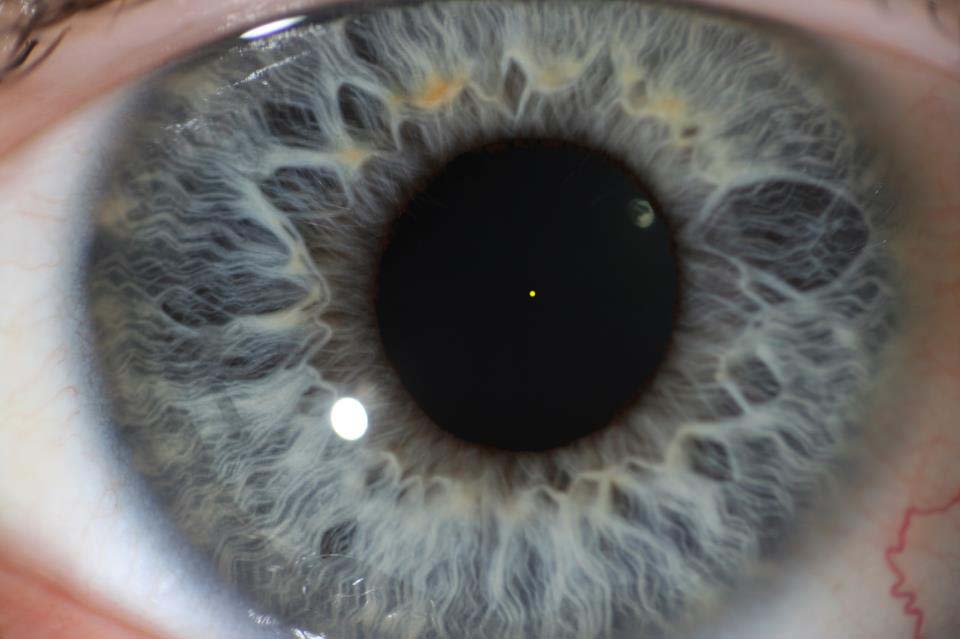 Modern & Multidimensional Iridology: The Dynamics of the Collarette ...