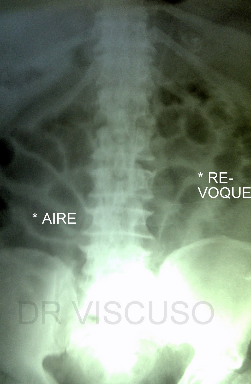 Que vi hoy: Signo de "revoque"