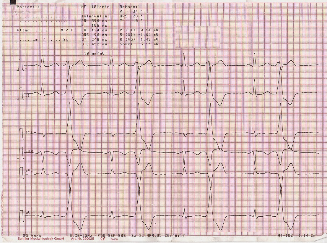 Cardiologul: Electrocardiograma – ECG