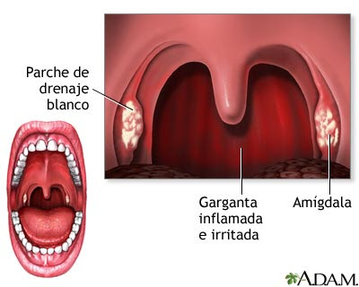 Nursing Diagnosis for Pharyngitis