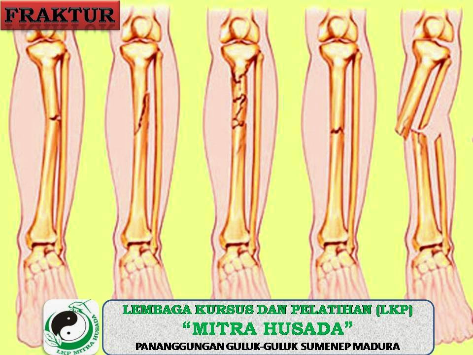 LKP MITRA HUSADA: PELATIHAN PENANGANAN PATAH TULANG