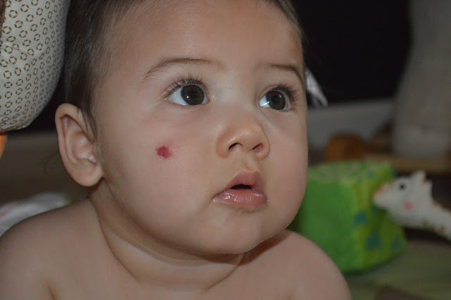 I Love Noah: Strawberry Birthmark