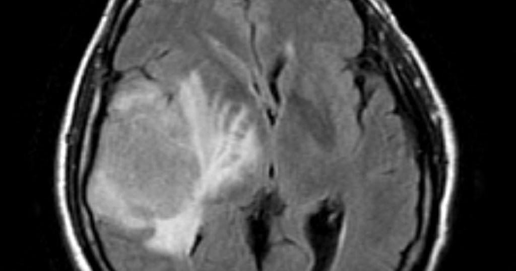 Esclerosis-Multiple-MSblog: Tumefactive Demyelinating Lesions ...