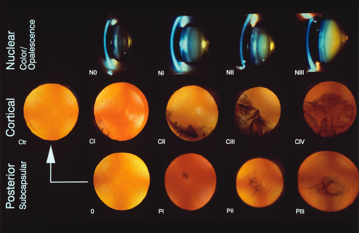 Recursos optométricos: LOCS III