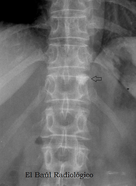 El Baúl Radiológico: ENOSTOSIS: ISLOTE ÓSEO (Bone Island: CT and MRI ...