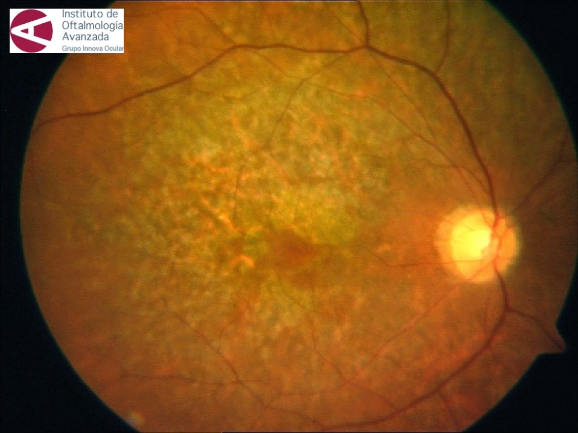 Miranza IOA: RETINOSIS PIGMENTARIA