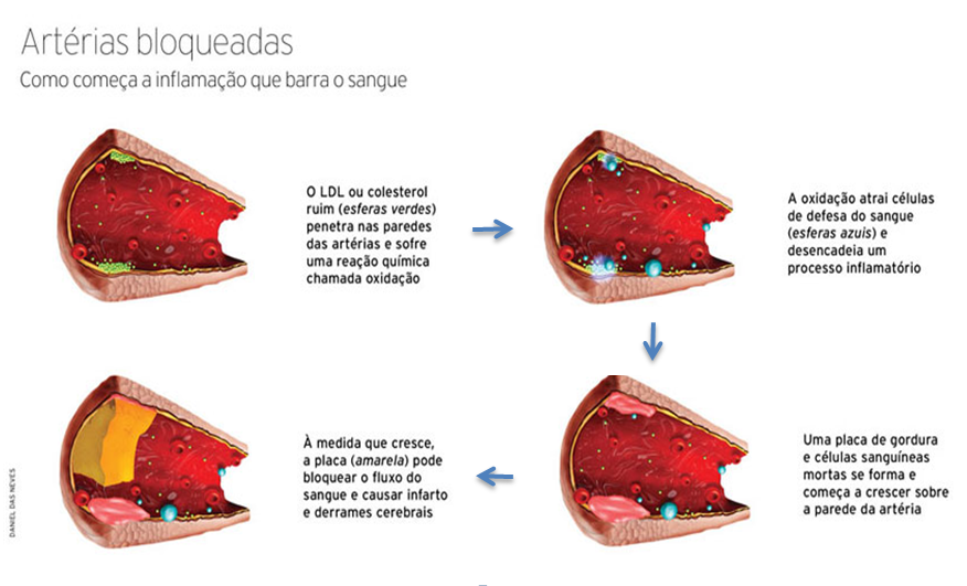 Hipertensão, Saúde Vascular e Óxido Nítrico: Aterosclerose e formação ...
