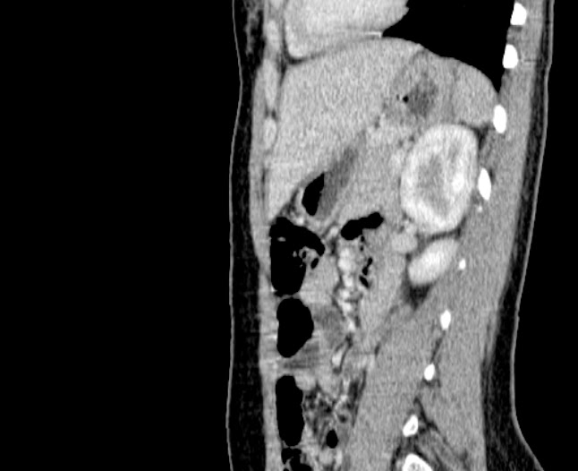 Ultimate Radiology : Pseudolesion : Papillary Process of Caudate Lobe