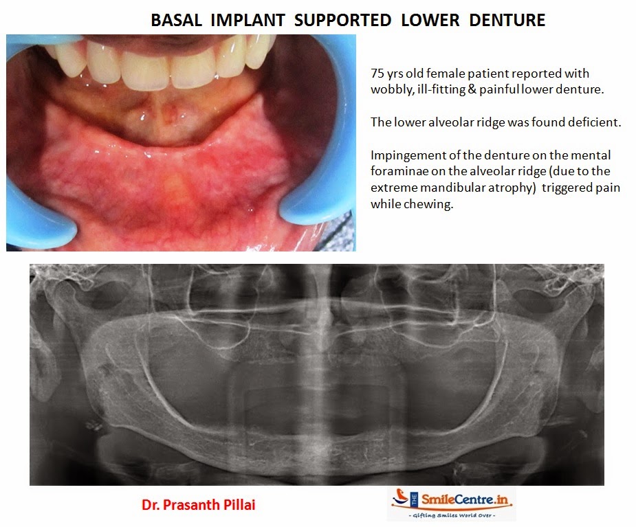 Dental Implants India: BASAL IMPLANT SUPPORTED LOWER DENTURE