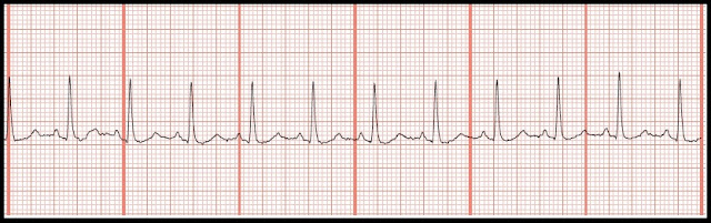 Characteristics of Sinus Rhythms