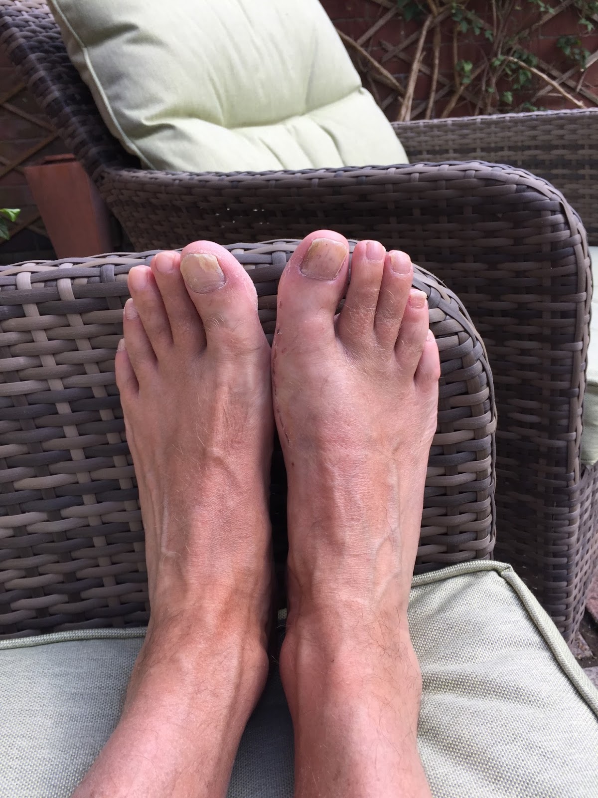 One Boot In Front Of The Other: The Cheilectomy......!!!