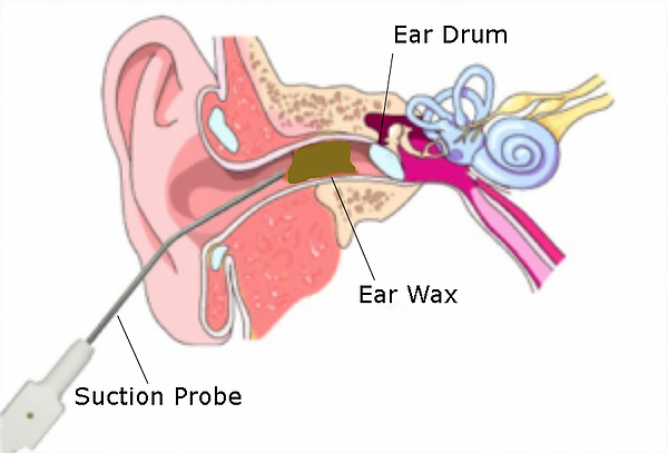 Ear Care Service: Earwax Accumulation and Ear Wax Removal!