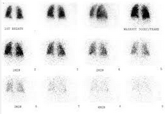 Nuclear Medicine Exams Explained - For The Patient: What Is A VQ Scan ...