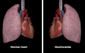 Ciências Biológicas 2016: (1_BIO_LIC_NB_Rafaelly_Sadovski) DEXTROCARDIA ...