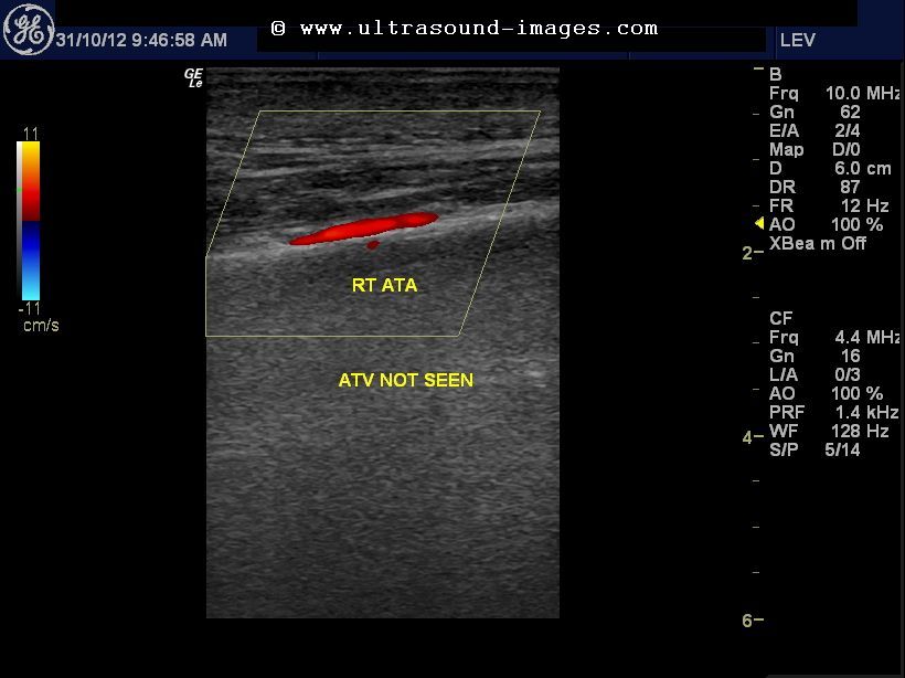 Deep-vein thrombosis- before and after treatment: ~ Ultrasound Cases Info