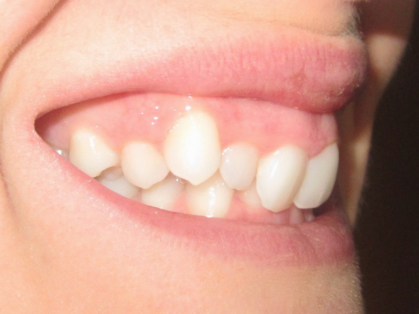 Creatively Titled Blog about Invisalign: "Before" Pictures