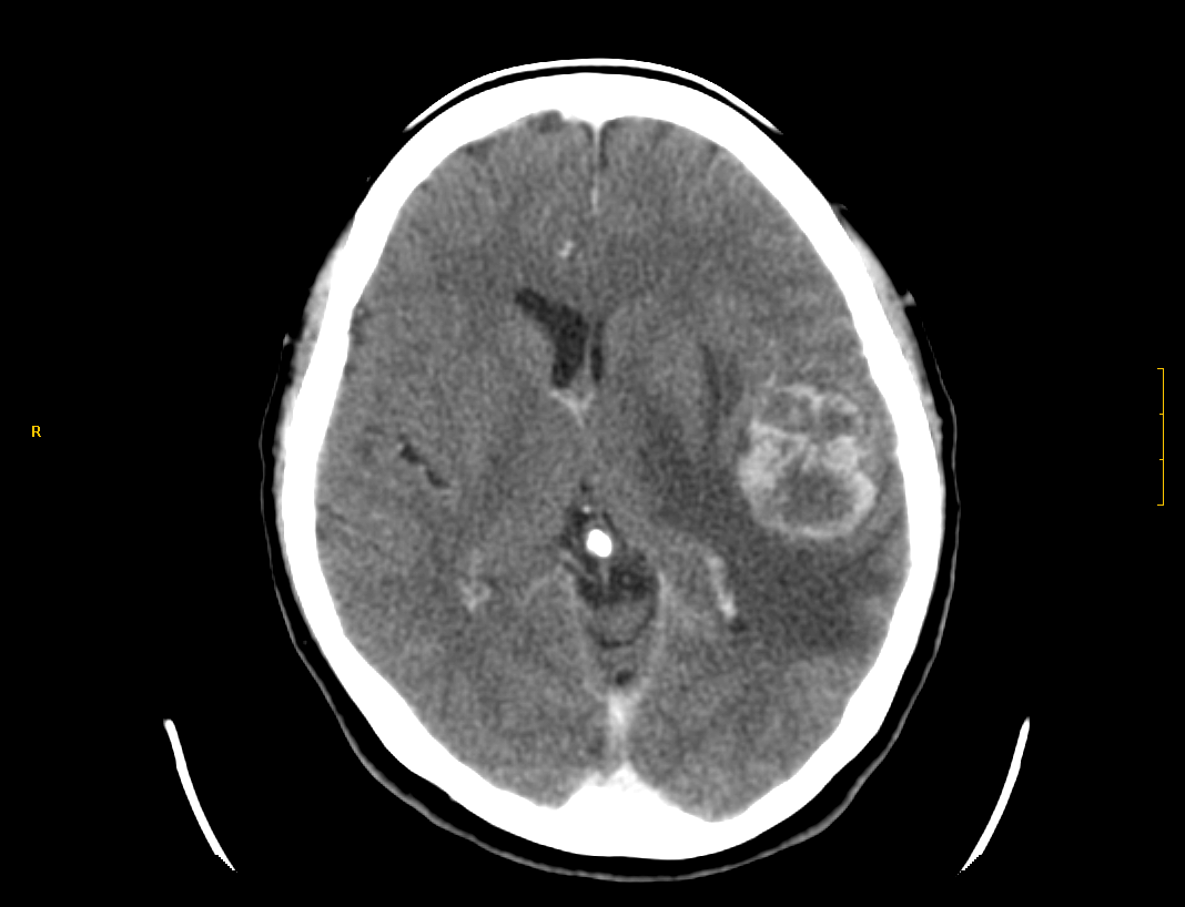 El Blog de Isa y Juan: LOE cerebral
