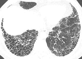 Chest Section: 5-3-Diffuse reticular pattern: