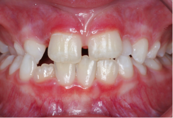 The POPA Blog: A New Syndrome for Dentistry: Dental Space Deficiency ...