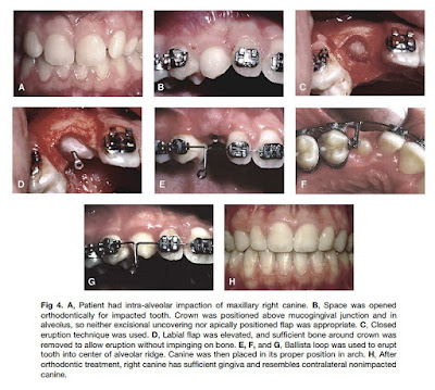 PDF: Surgical and orthodontic management of impacted maxillary canines