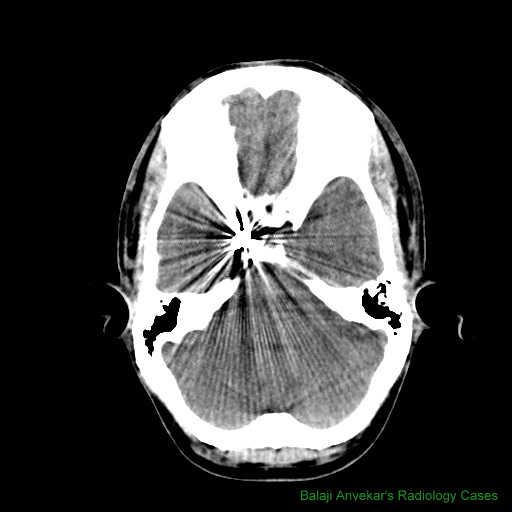 Dr Balaji Anvekar Frcr Streak Artifacts Ct