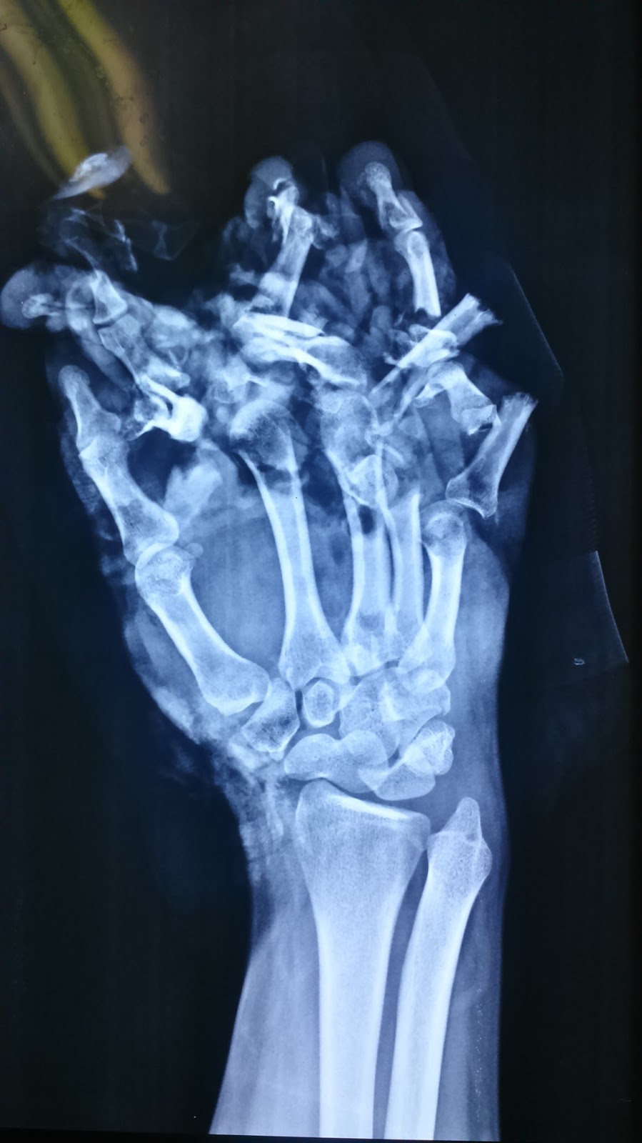 O R T O C R I T I C A: MANO TRAUMATICA