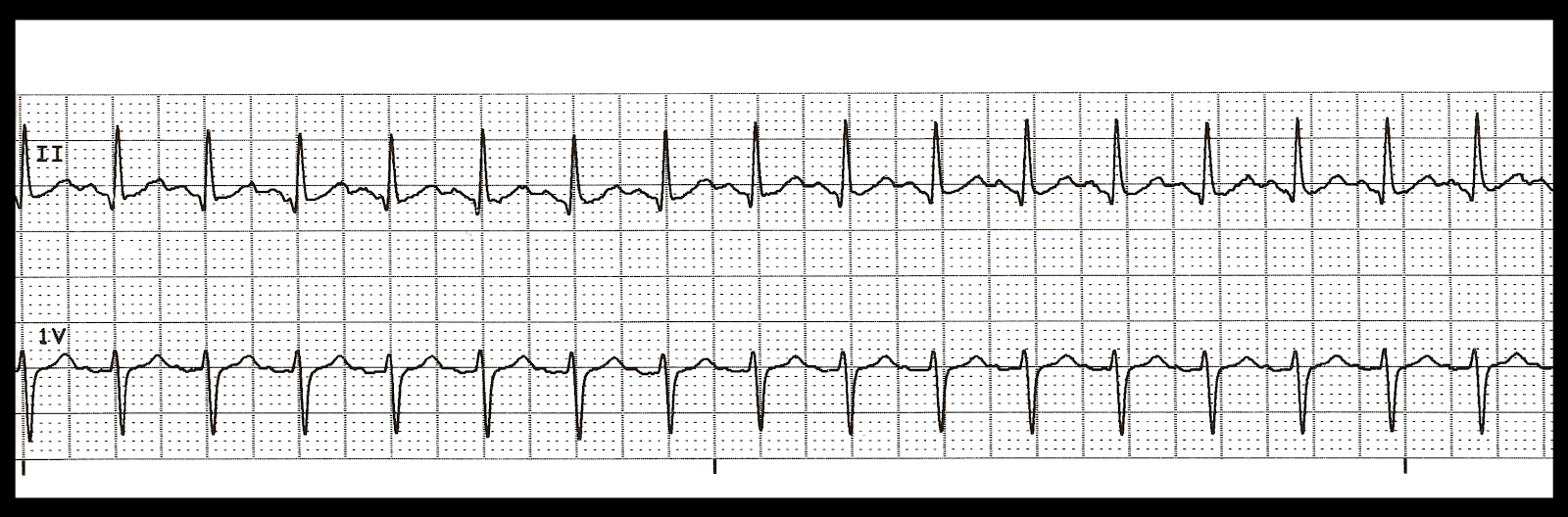 Practice EKG Strips 409